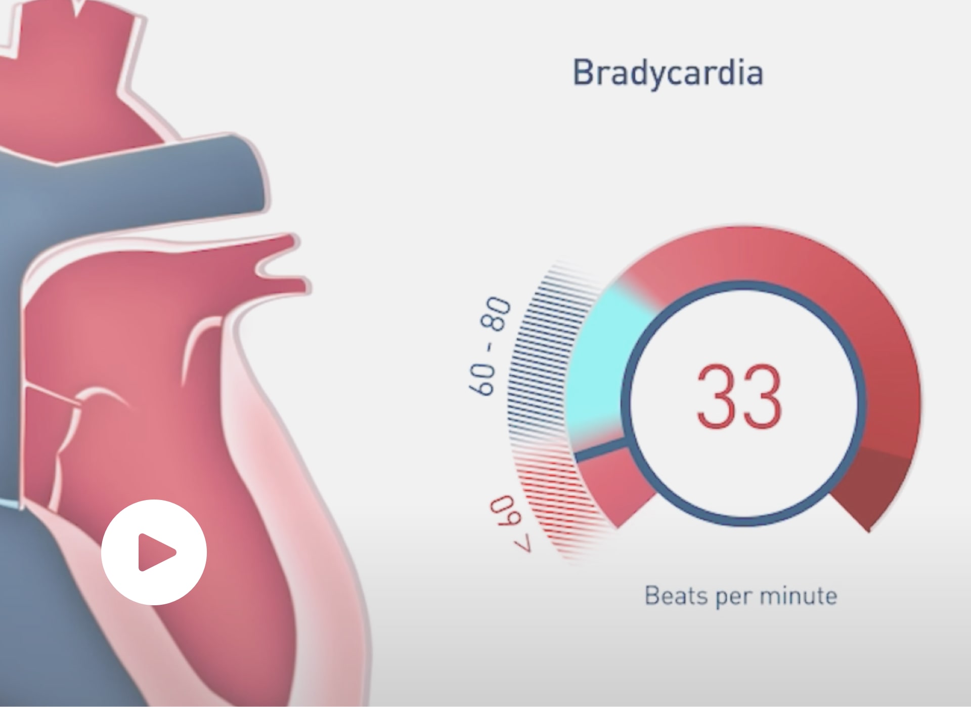 How Pacemakers Work - Cordis